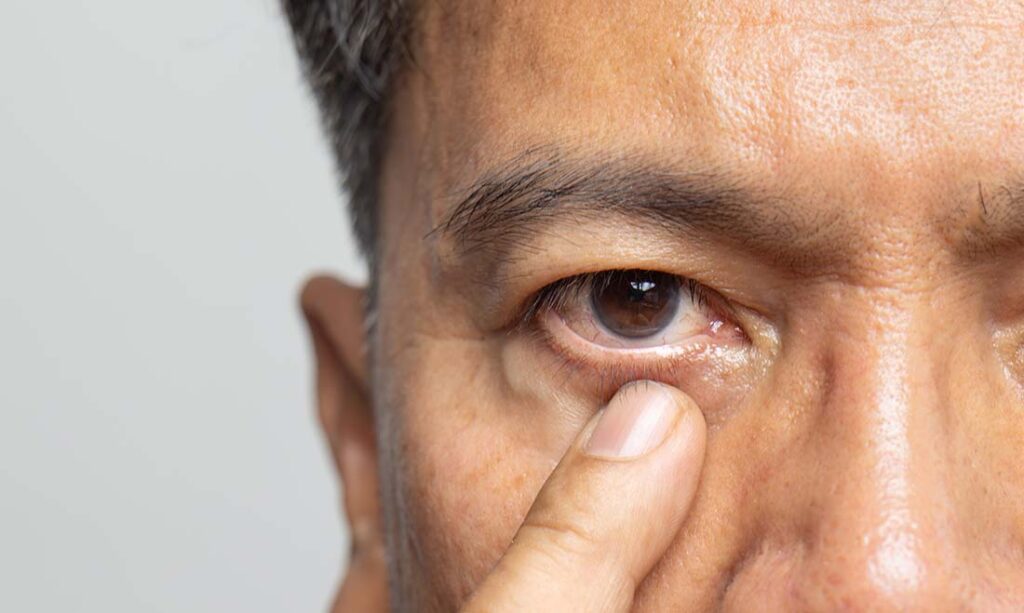 Early Signs of Cataracts | WK Eye Institute
